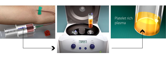 PRP Therapy - Panhandle Orthopaedics