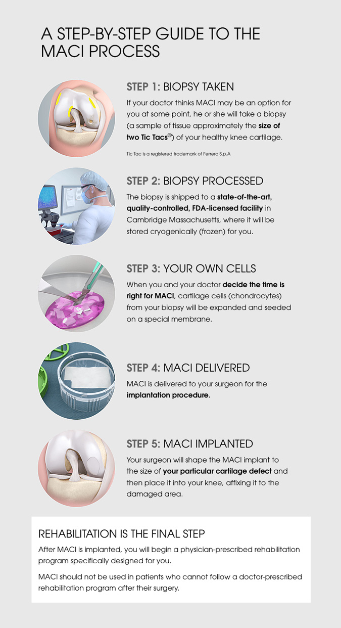 About MACI Cartilage Repair - Panhandle Orthopaedics